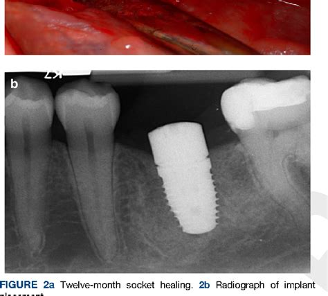Figure 2 From The Use Of A Xenogeneic Collagen Matrix As An Interpositional Soft Tissue Graft To