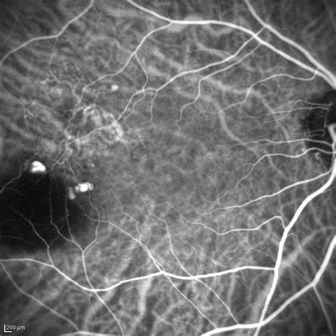 Polypoidal Choroidal Vasculopathy