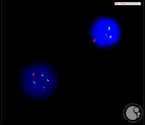 Atypical Fish Signal Pattern In Apl Acute Promyelocytic Leukemia