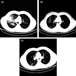CT Scan Images A The CT Result On Admission Day B The CT Result Download Scientific Diagram