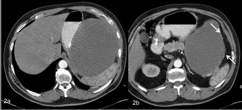 Haemorrhagic Gastric Gist Eurorad