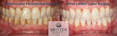 Periodontal Disease Before And After Pictures