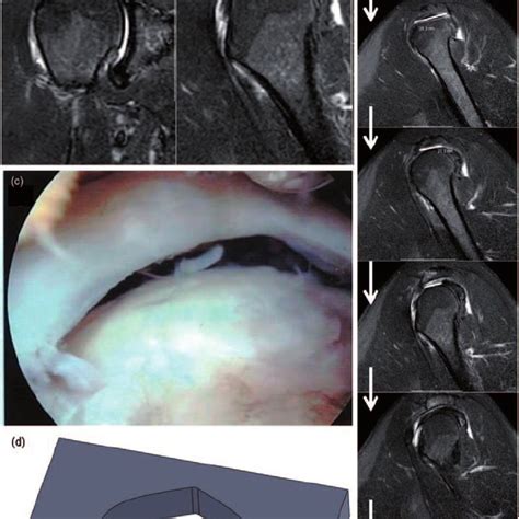 A Massive Supraspinatus Tear Evaluated On A T2 With Fat Saturation