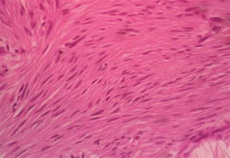 Microscopic Appearance Of The Ileal Malignant Gist Stained With