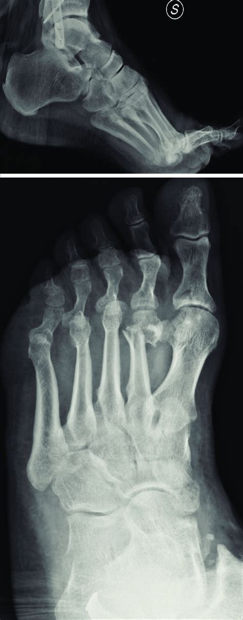 Preoperative Left Foot Radiographs With Fractures Of The Second And