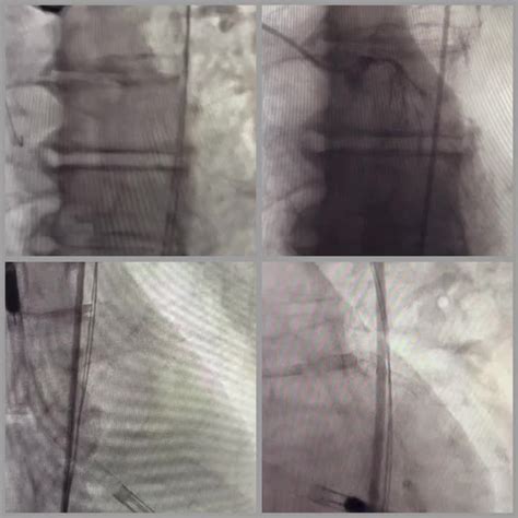 Michael Megaly On Linkedin Diabetic Male Undergoing Fem Pop Bypass