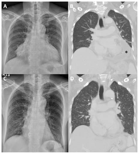 Paradoxical Response With Miliary Pulmonary Nodules In A Patient With