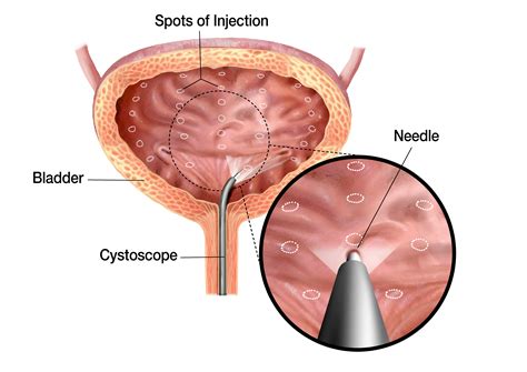 Botox For Overactive Bladder United Urology