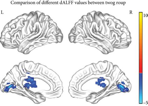 Comparison Of Different Dalff Values Between Lb Group And Sc Group