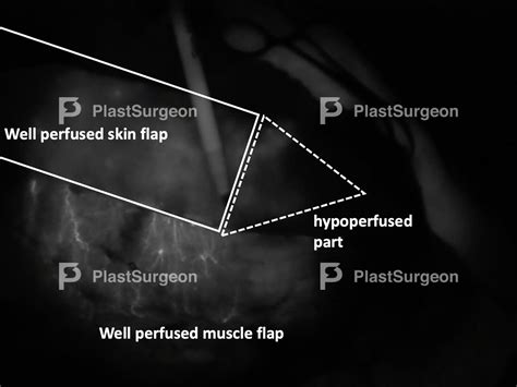 Case 4 Extensive Scalp Reconstruction Using A Free Myocutaneus