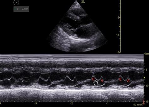 Normal Ef Epss Quantified M Halperin Bronx Ny — Everyday Ultrasound