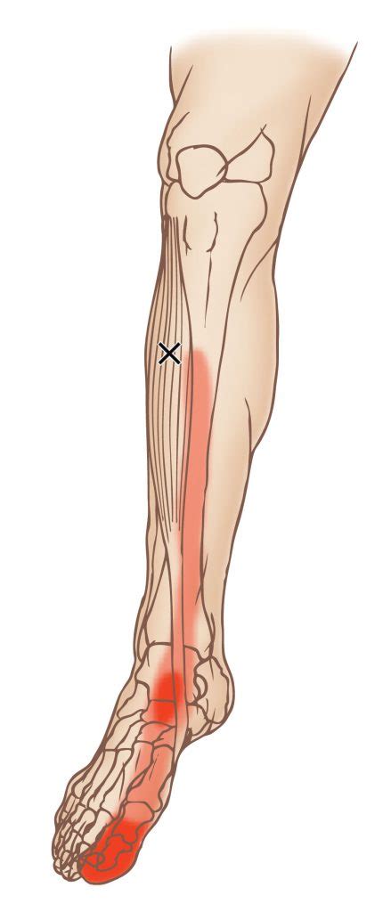 Tibialis Anterior Trigger Point Learn Muscles Tibialis Anterior Trigger Point Learn Muscles