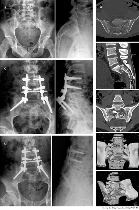 Sacral Foramina Xray