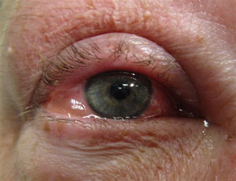 What Is Pharyngoconjunctival Fever