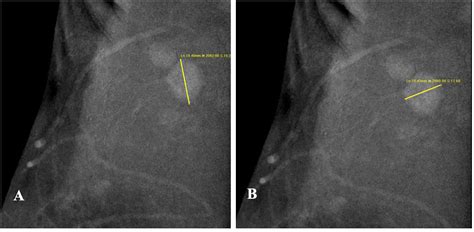 Enhancing Specificity In Predicting Axillary Lymph Node Metastasis In Breast Cancer Through An