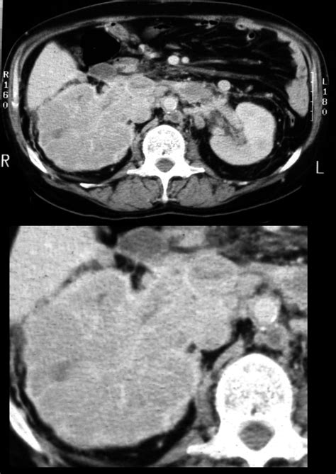 If Finding Nephrogram Phase Delayed The Common Vein