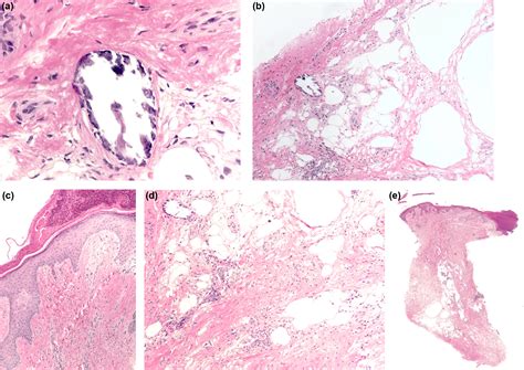 Manifestation Of Nonuremic Calciphylaxis In The Extremities Case
