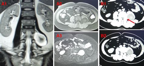 Preoperative Mri And Ct Showed Lumbar Dumbbell Shaped Tumor Of A Download Scientific Diagram