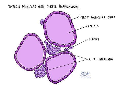 Medullary Thyroid Carcinoma Mypathologyreportca