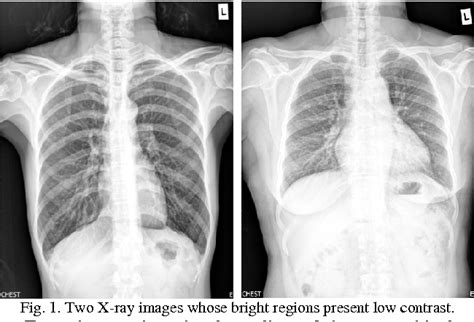 Figure 1 From X Ray Imaeg Contrast Enhancement Based On Tissue