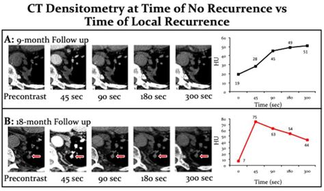 Computed Tomography Densitometry And Morphology Of Radiofrequency Ablated Stage Ia Non Small