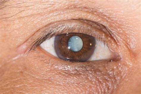 White Spot On The Eye What It Could Be And When To Go To The Doctor