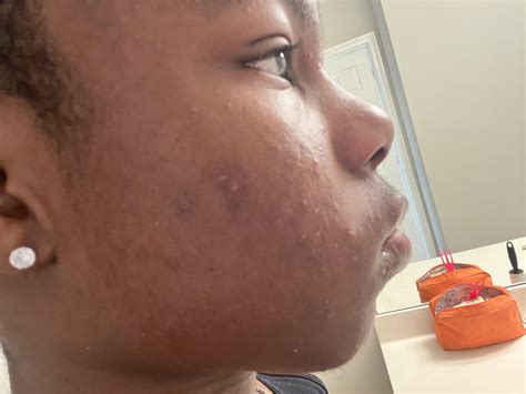 [product Question] Does My Skin Looks Like It Needs A Panoxly Wash Added R Skincare Addiction