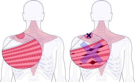 Proposed Trigger Point Anatomy Normal Left V Tense Right Muscle Download Scientific