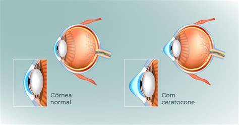 Qual A Causa Do Ceratocone Neooftalmo