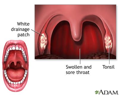 White Spots On Tonsils And Cold Symptoms