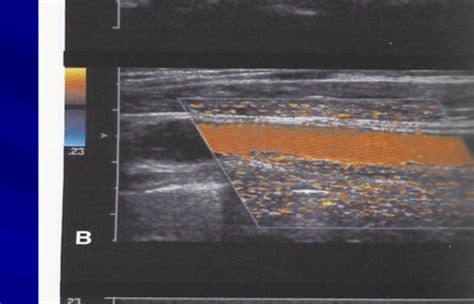 Module Optimizing Doppler Imaging Flashcards Quizlet