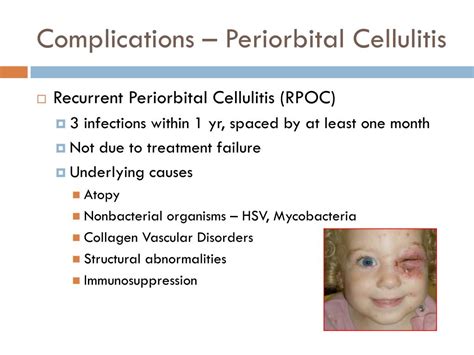 Ppt Periorbital Vs Orbital Cellulitis Powerpoint Presentation Free Download Id2224443