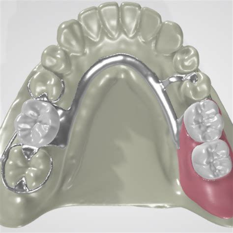 🦷 Prosthodontics Kennedy Class Ii Mod 1 Removable Partial Dentures Lower Jaw・ Stl File For 3d