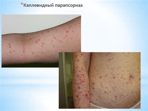 Парапсориаз - online presentation