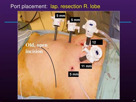Ppt Surgical And Ablative Strategies For Metastatic Colorectal Cancer
