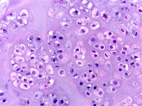 Enchondroma Histology