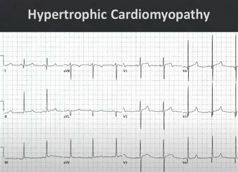 6 11 Another Example Of Ecg Of Hypertrophic Cardiomyopathy