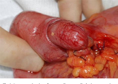 Figure 1 From Intussusception Of The Appendix Secondary To Mucinous