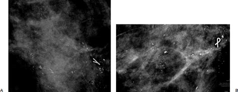 Calcifications Fine Linearbranching Microcalcifications Radiology Key