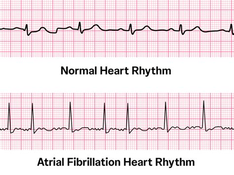 Afib Rung Nhĩ Hiểu Biết Đầy Đủ Về Nguyên Nhân Triệu Chứng Và Điều Trị