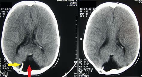Radiographic Keyhole