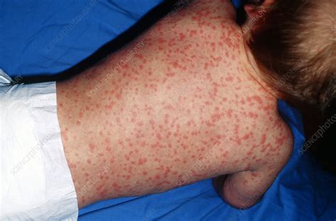 Allergy Rash From Antibiotics At Timothy Stump Blog