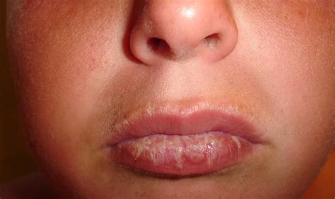 Sunburned Lips