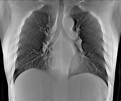 Next Generation Digital Chest Tomosynthesis Journal Of Clinical Imaging Science