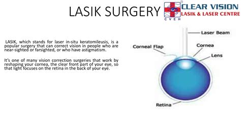 Ppt Clear Vision Lasik Pdf Powerpoint Presentation Free Download