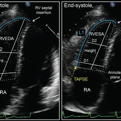 Change In RV Measurements From An RV Focused View To An Unfocused View Download Scientific