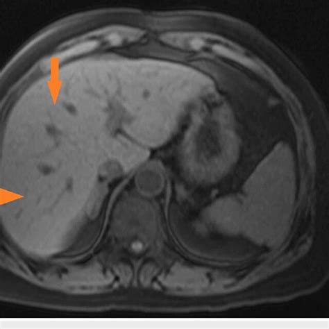 Mrcp Sagittal And Axial Planes Revealing Cholelithiasis Blue Arrows Download Scientific