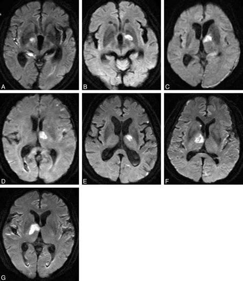 Diffusion Weighted Imaging On The First Day After Surgery For Download Scientific Diagram