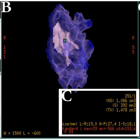 Example Of Nodule Three Dimensional Processed And Measured On