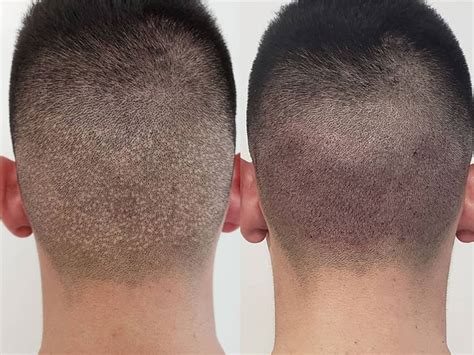 Hair Transplant Before And After Scar
